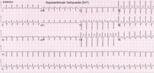 Treating patients with supraventricular tachycardia (SVT) - SWAST CPD